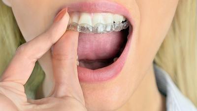 Invisalign, ClearCorrect, or Inman? Choosing Invisible Braces